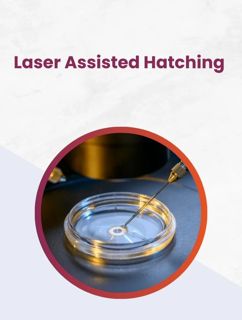 Laser-Assisted Hatching Treatment: Procedure, Preparation, Pros and Cons